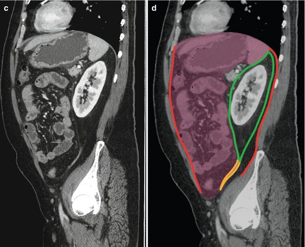 The Extraperitoneal Spaces | SpringerLink