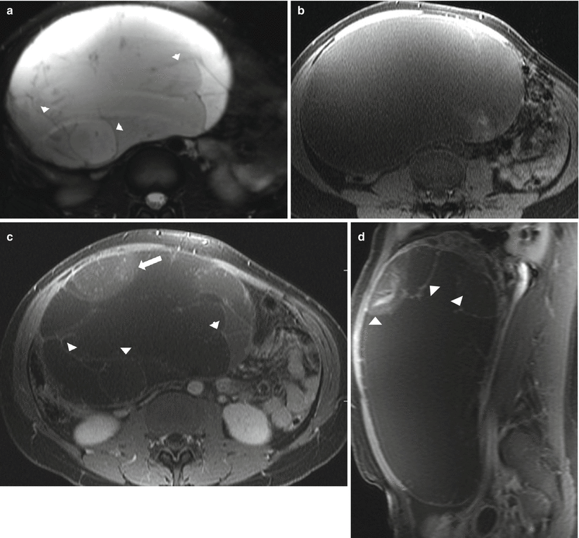 The Extraperitoneal Spaces | SpringerLink