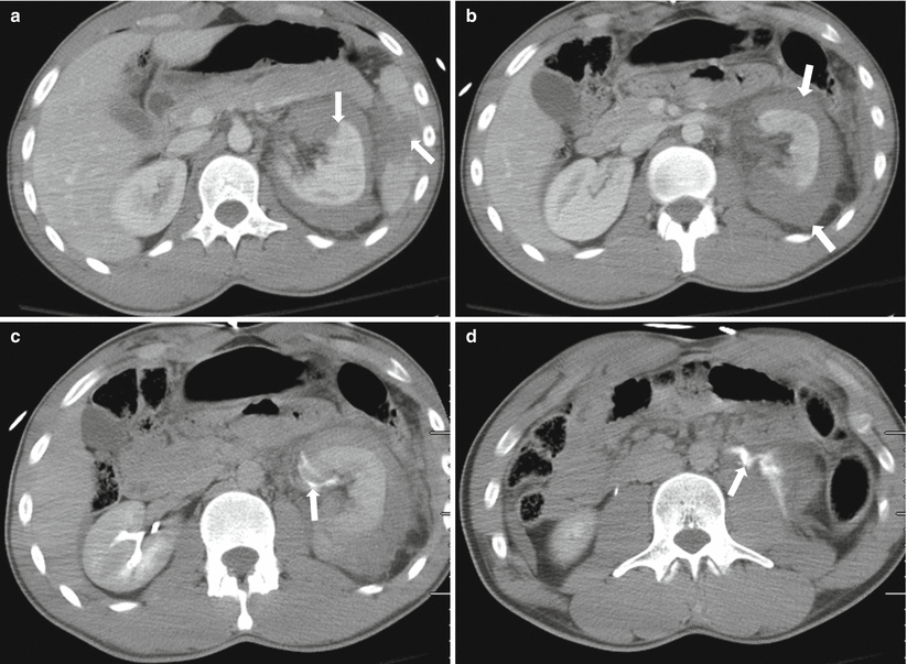 The Extraperitoneal Spaces | SpringerLink