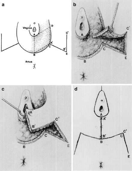 Cancer of the Vulva and Vagina | SpringerLink