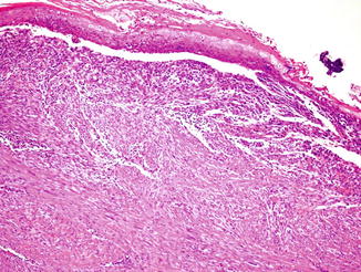 Atypical Fibroxanthoma/Undifferentiated Pleomorphic Sarcoma ...