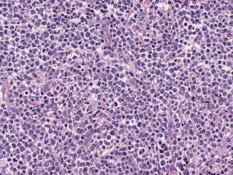 Diffuse Large B-cell Lymphoma: Leg Type | SpringerLink