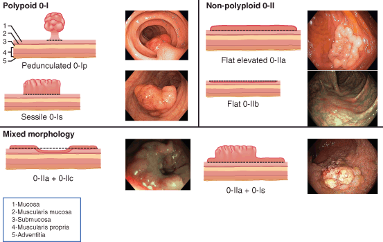 Colon Widefield Endoscopic Mucosal Resection | SpringerLink