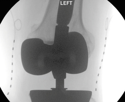 Peripheral Nerve Stimulation for the Treatment of Knee Pain | SpringerLink