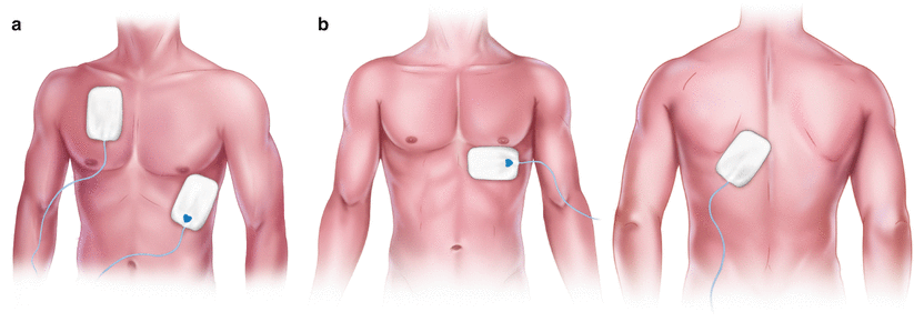 Transcutaneous Pacing | SpringerLink