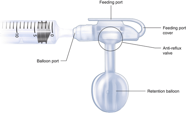 Gastrostomy Tube Placement | SpringerLink