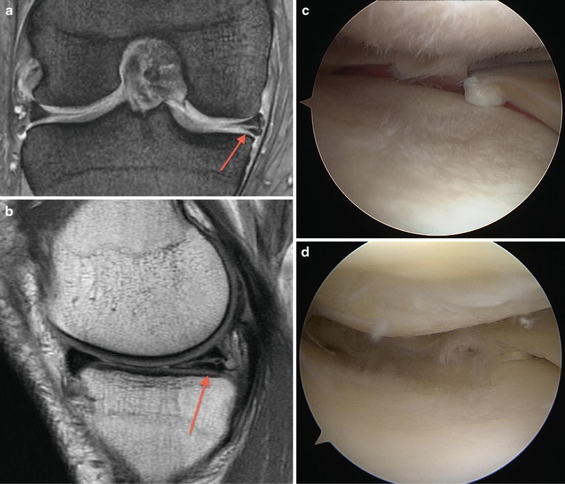 Meniscus Tear MRI Correlation | SpringerLink