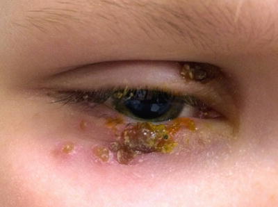 Pediatric Herpes Virus Anterior Segment Infections | SpringerLink