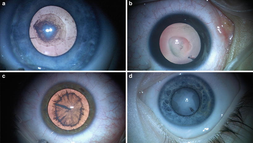 Management of Infantile and Childhood Cataracts | SpringerLink