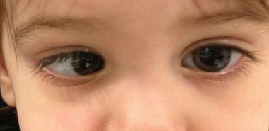 Sixth Nerve Palsy in Children | SpringerLink