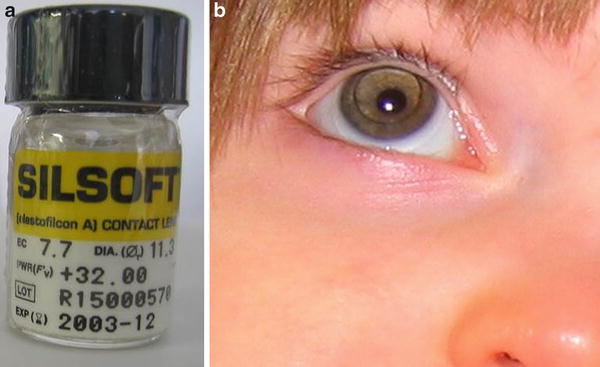 Pediatric Contact Lenses for Medical Indications | SpringerLink