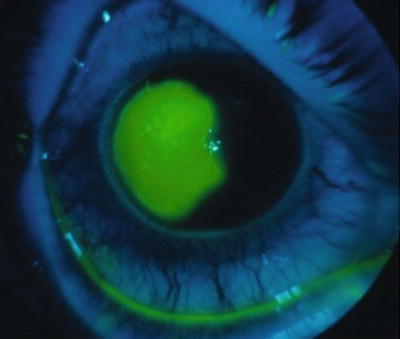 Nasolacrimal Duct Obstruction | SpringerLink