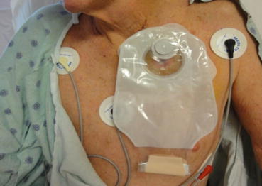 Esophagostomy Management | SpringerLink