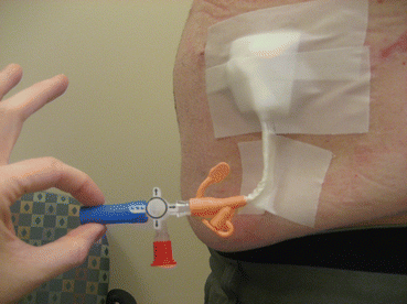 Esophagostomy Management | SpringerLink