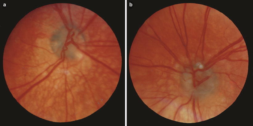 Congenital Optic Nerve Anomalies | SpringerLink