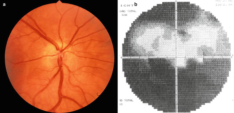Congenital Optic Nerve Anomalies | SpringerLink
