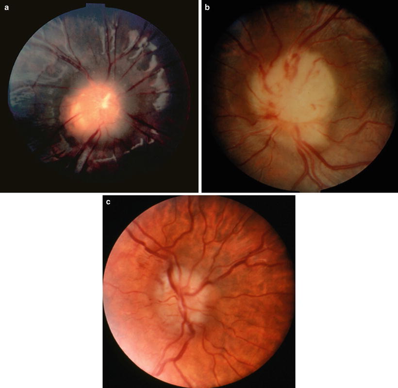 The Swollen Optic Disc in Children | SpringerLink