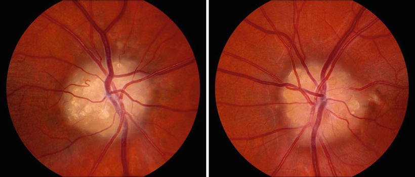 The Swollen Optic Disc in Children | SpringerLink