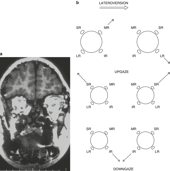Complex Ocular Motility Disorders in Children | SpringerLink
