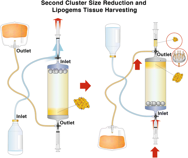 Mesenchymal Stem Cells in Lipogems, a Reverse Story: from Clinical ...