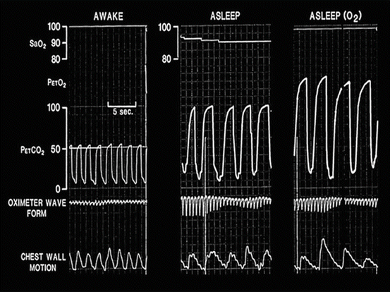 Care of the Child with Congenital Central Hypoventilation Syndrome ...