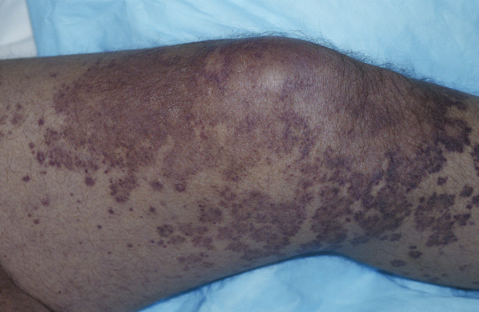 Urticaria and Angioedema | SpringerLink