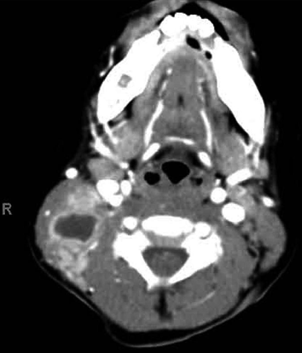 Methicillin-Resistant Staphylococcus aureus (MRSA) Infections of the ...
