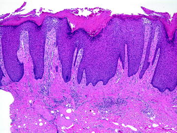 Psoriasiform Dermatitis | SpringerLink