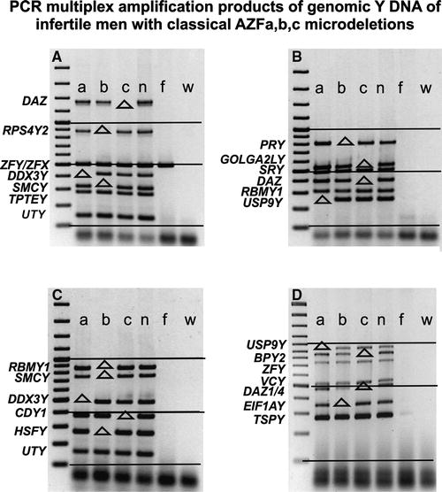 Human Y Chromosome Microdeletion Analysis by PCR Multiplex Protocols ...