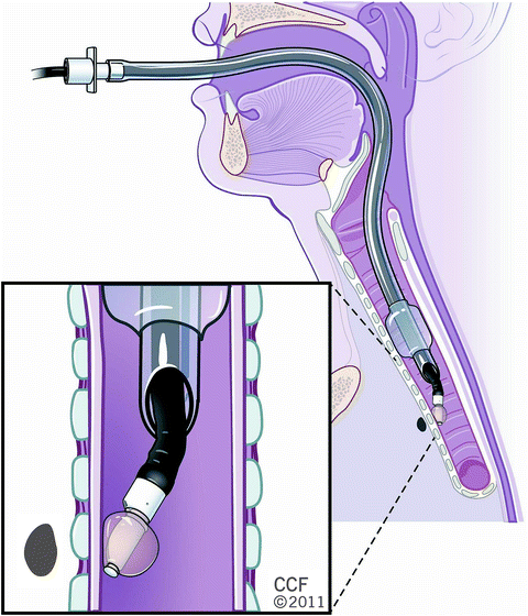 EBUS-TBNA Bronchoscopy | SpringerLink