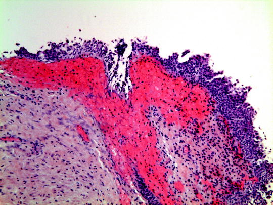 Hemorrhagic Cystitis | SpringerLink