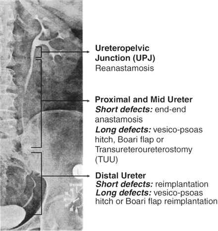 Traumatic Ureteral Injuries | SpringerLink