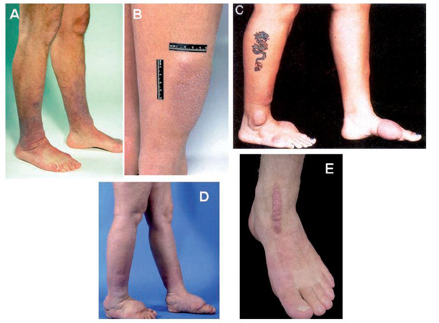Pretibial Myxedema (Thyroid Dermopathy) | SpringerLink