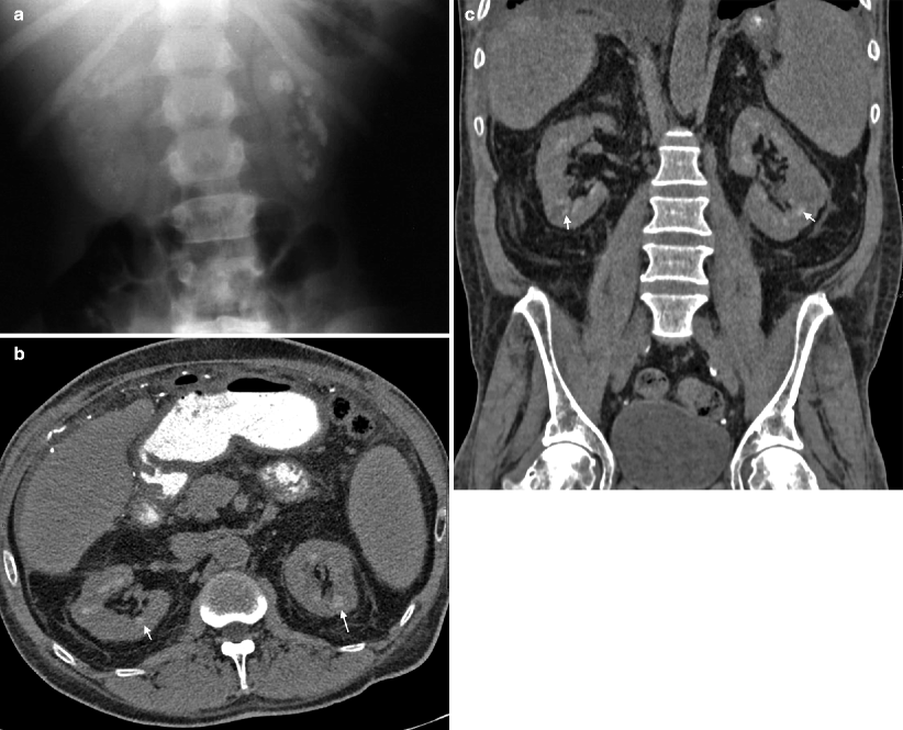 Renal Calculus Disease | SpringerLink