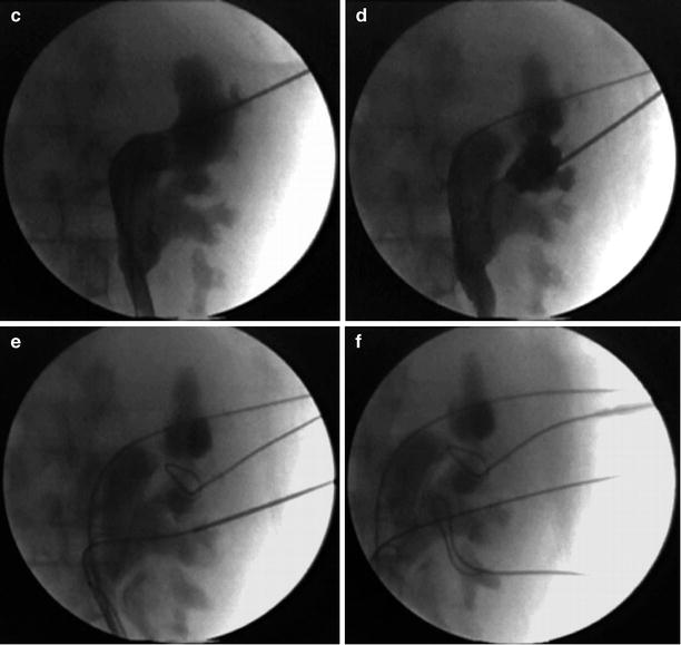 Percutaneous Nephrolithotomy | SpringerLink