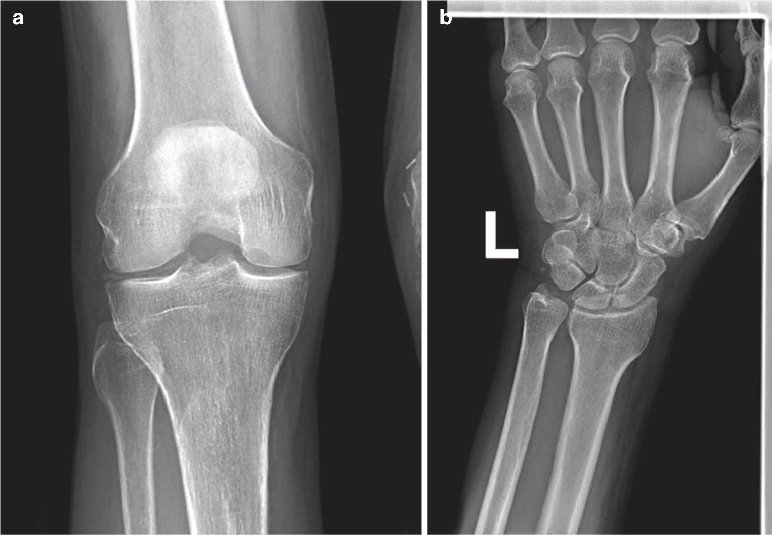 Calcium Pyrophosphate Dihydrate (CPPD) Crystal Deposition Disease ...