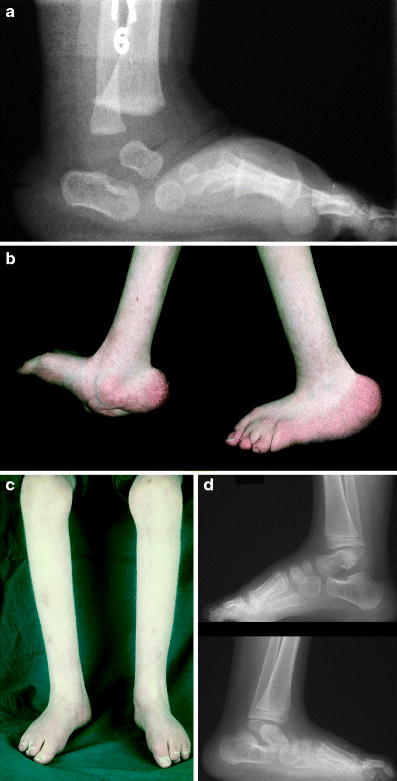 Congenital Vertical Talus (Congenital Convex Pes Valgus) | SpringerLink