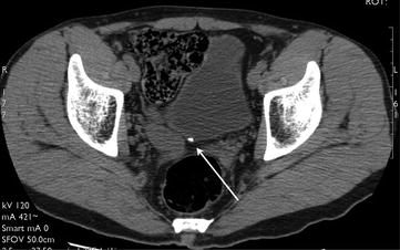 Intraluminal Abnormalities of the Bladder | SpringerLink