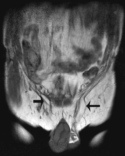 Diagnosis of a Lump in the Groin in the Adult | SpringerLink