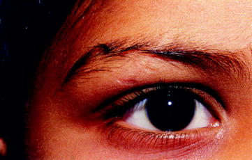 External Angular Dermoid and Pilomatrixoma | SpringerLink