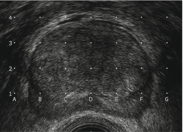 Transperineal Template-guided Mapping Biopsy of the Prostate | SpringerLink