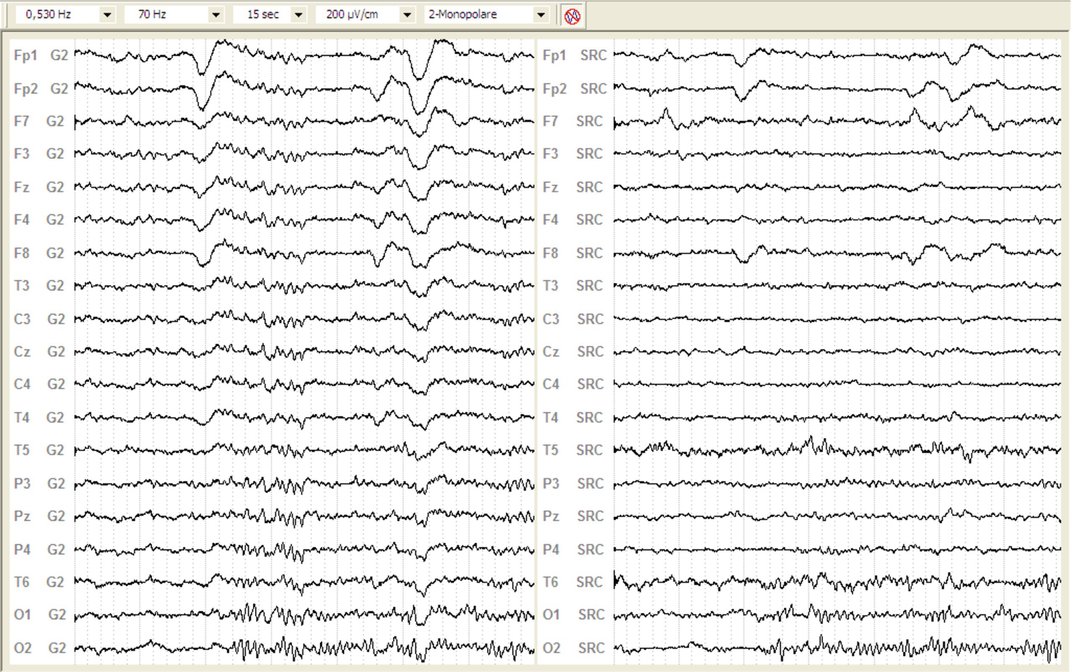EEG Signal Acquisition | SpringerLink
