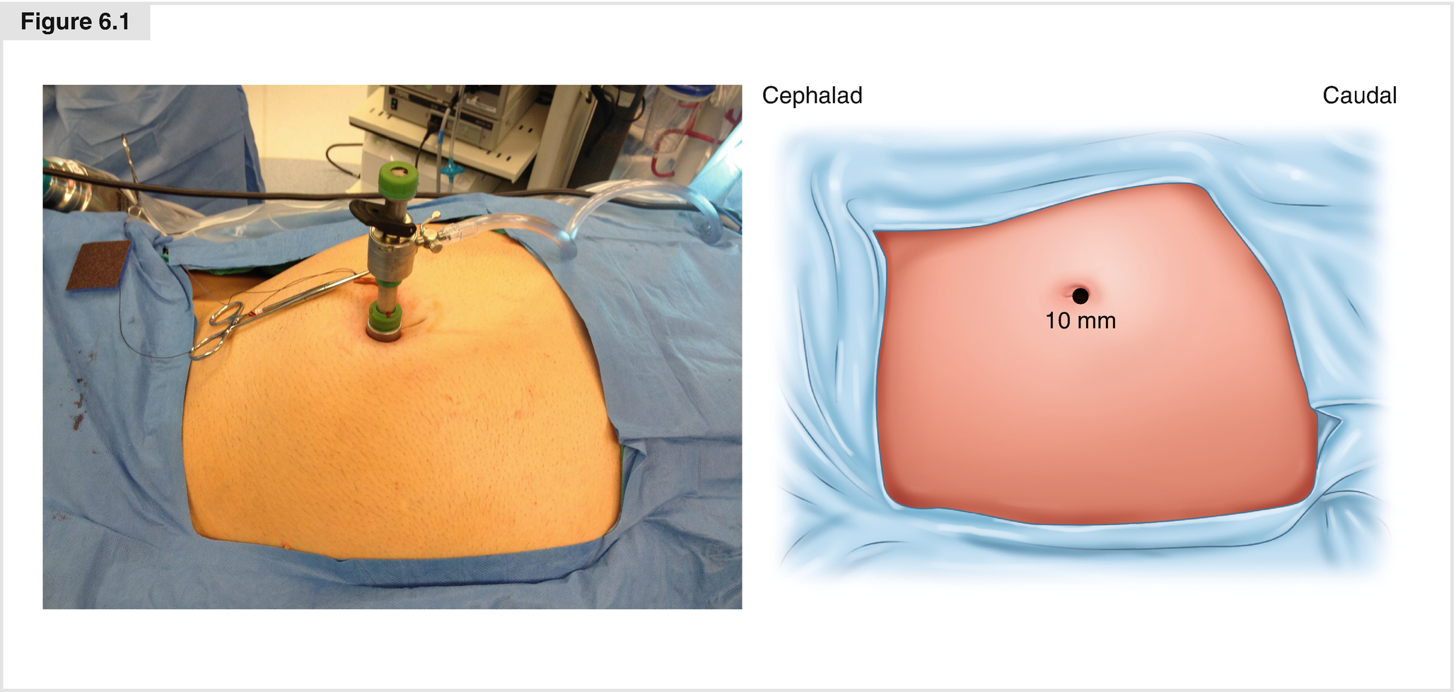 Laparoscopic Extended Right Colectomy | SpringerLink