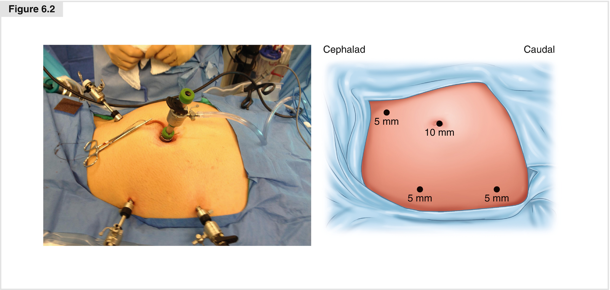 Laparoscopic Extended Right Colectomy | SpringerLink