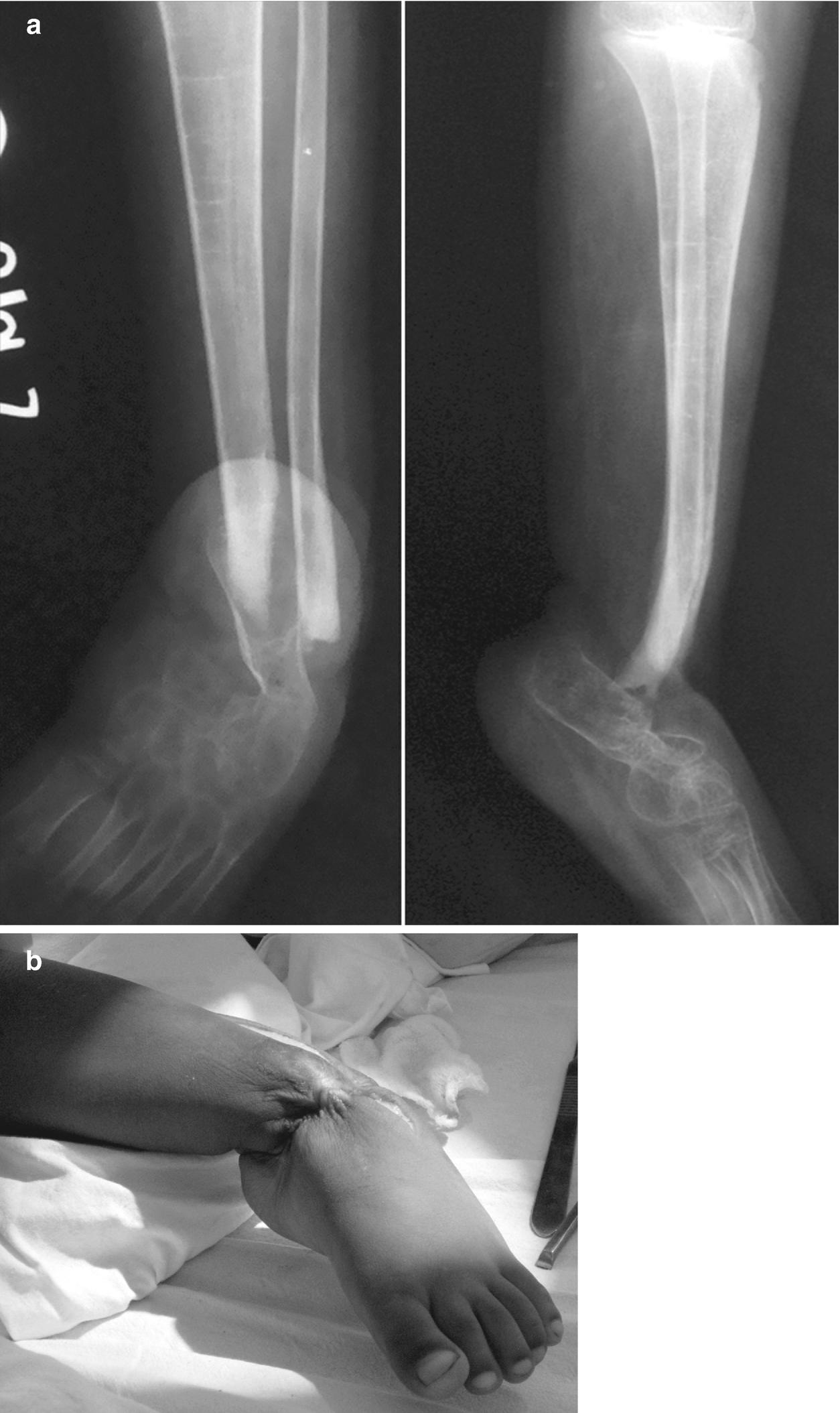 Neglected Septic Arthritis in Children | SpringerLink
