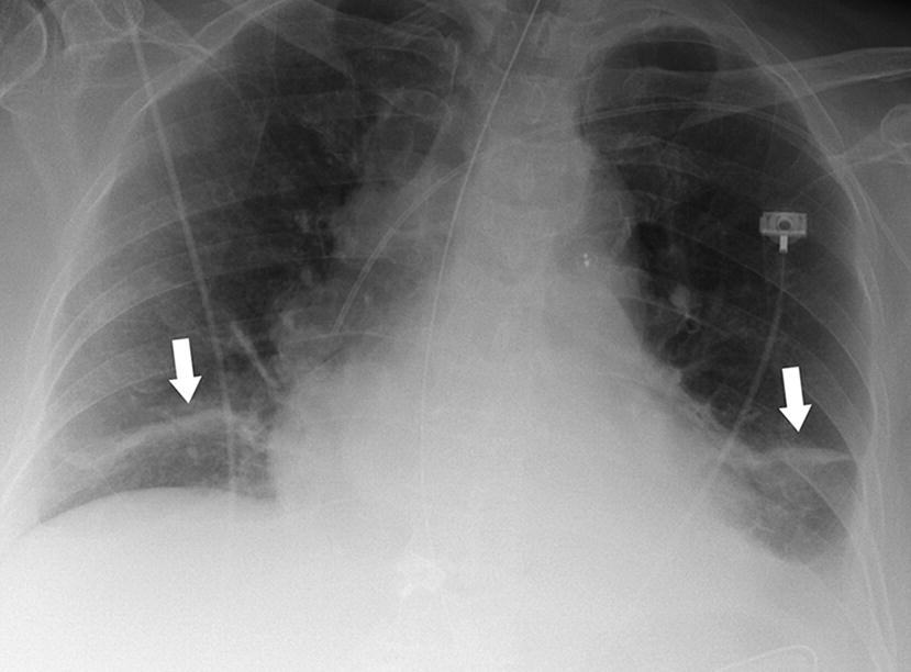 Volume Loss | SpringerLink