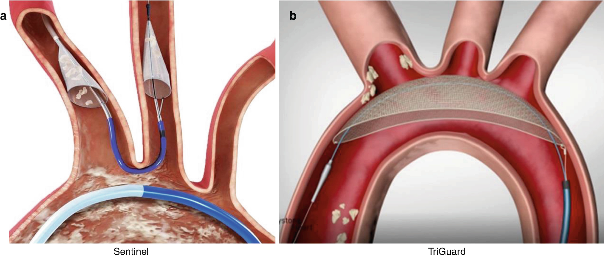 Transcatheter Aortic Valve Therapies | SpringerLink