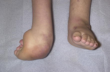 Correction of Untreated Severe Talipes Equinocavovarus Deformity in ...
