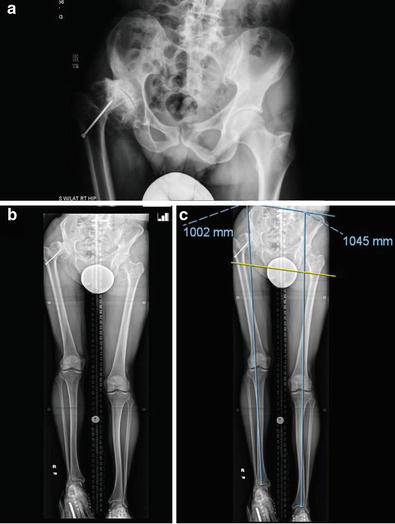Advanced Hip Arthrosis, Massive Perceived LLD, and Pelvic Obliquity due ...