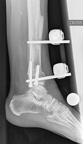 Supramalleolar Dome Osteotomy for Malunion of the Tibia | SpringerLink